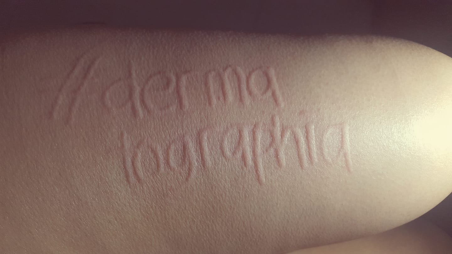 Can Dermatographia Be Cured Completely Over Time? - Dermatographia.com