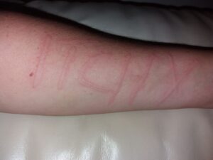 Dermatographia Causes: What Triggers This Mysterious Skin Condition ...