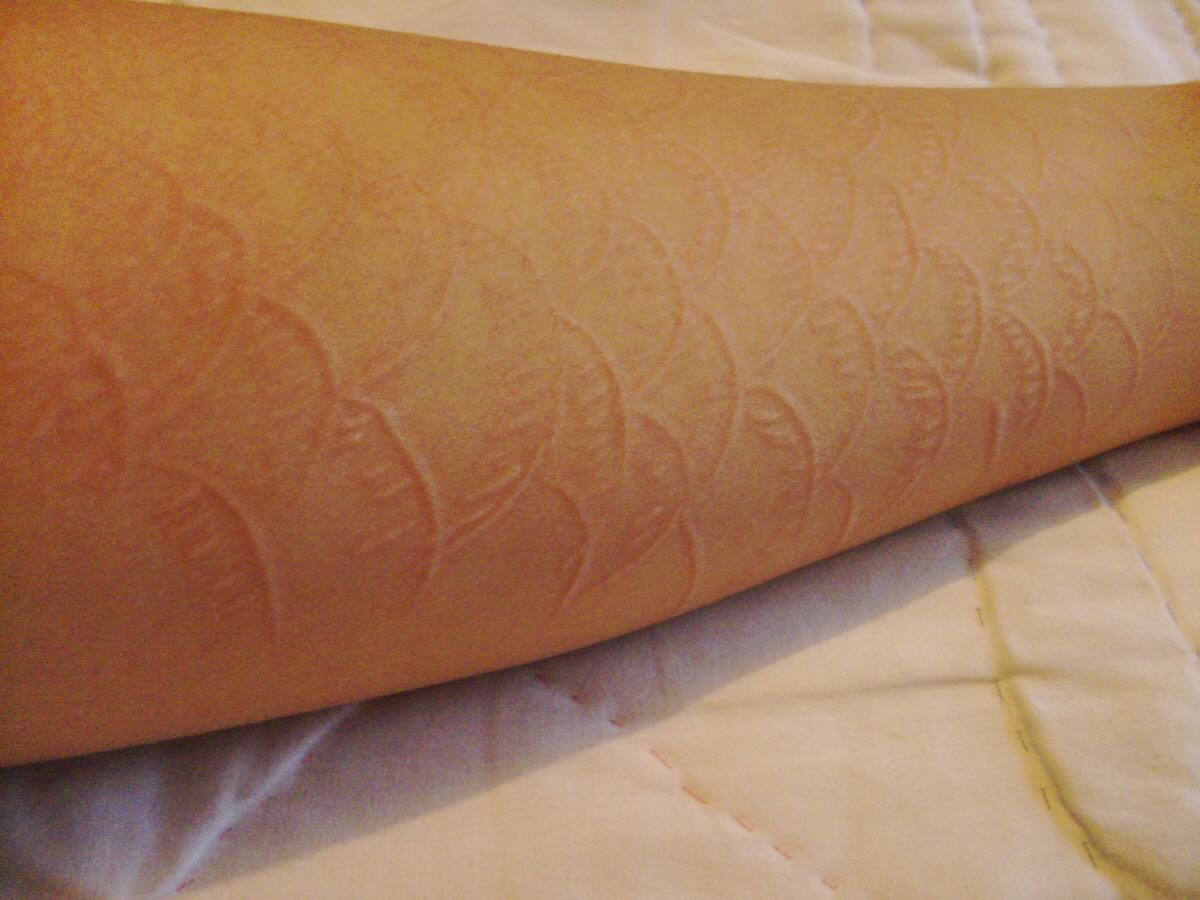 17 Pictures of Dermatographia on the Body - Dermatographia.com